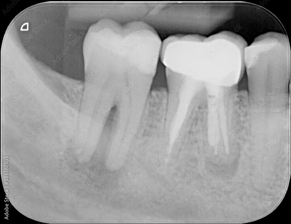 X-ray of two human tooth molars, both showing infections. One has an ...