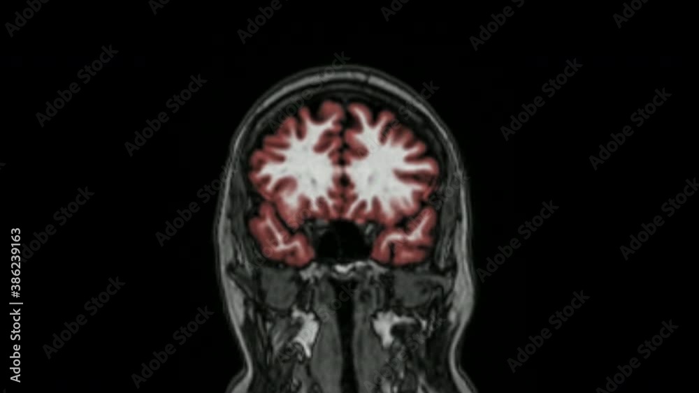 Magnetic resonance imaging of the brain in coronal plane color coded ...