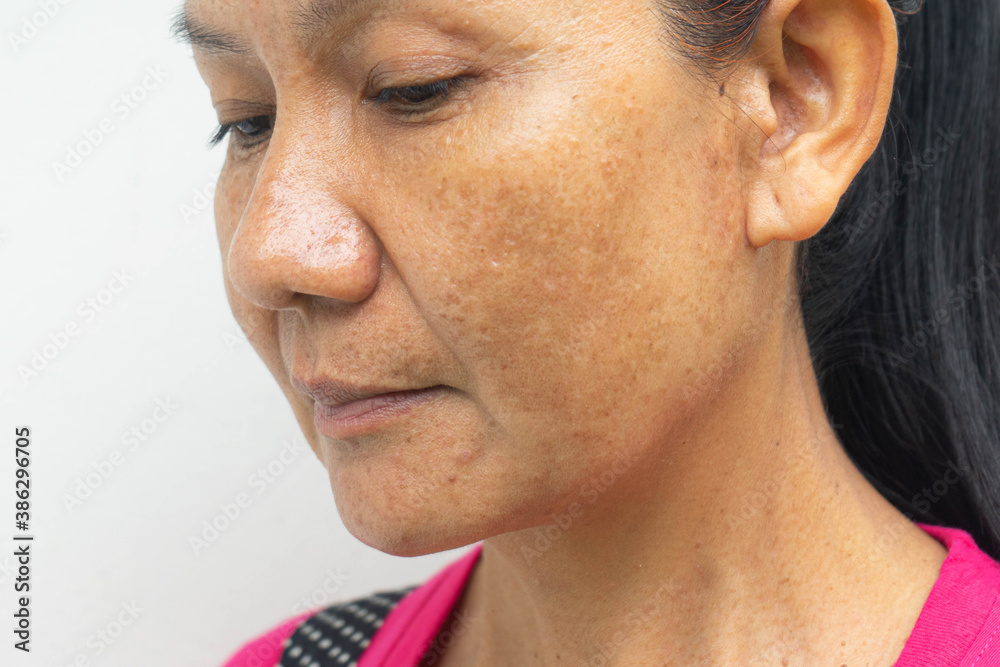 Woman problem skin face blemish on white background Stock Photo | Adobe ...