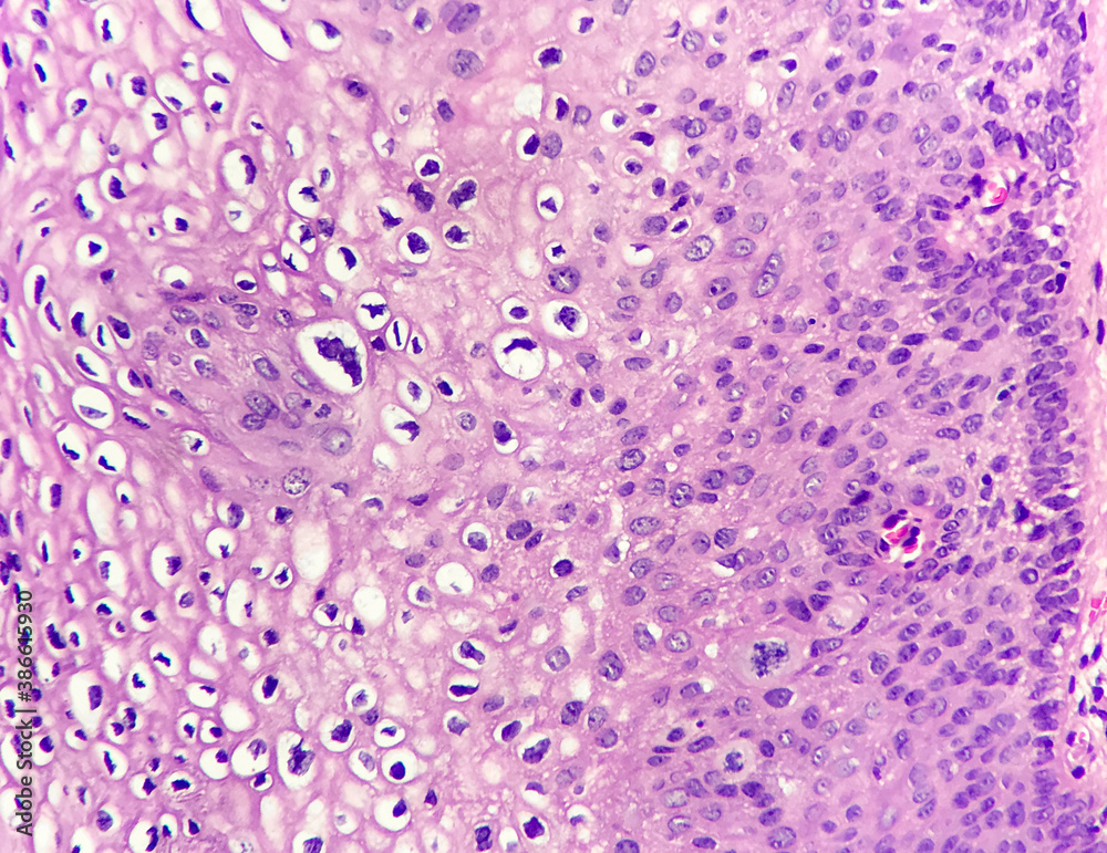 Cervix displays HPV (human papilloma virus) cytopathic effect ...