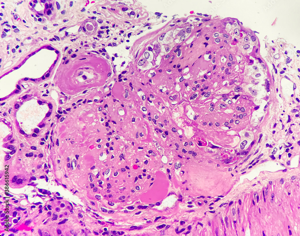 Glomerulus reveals nodular sclerosis and hyaline arteriolosclerosis ...