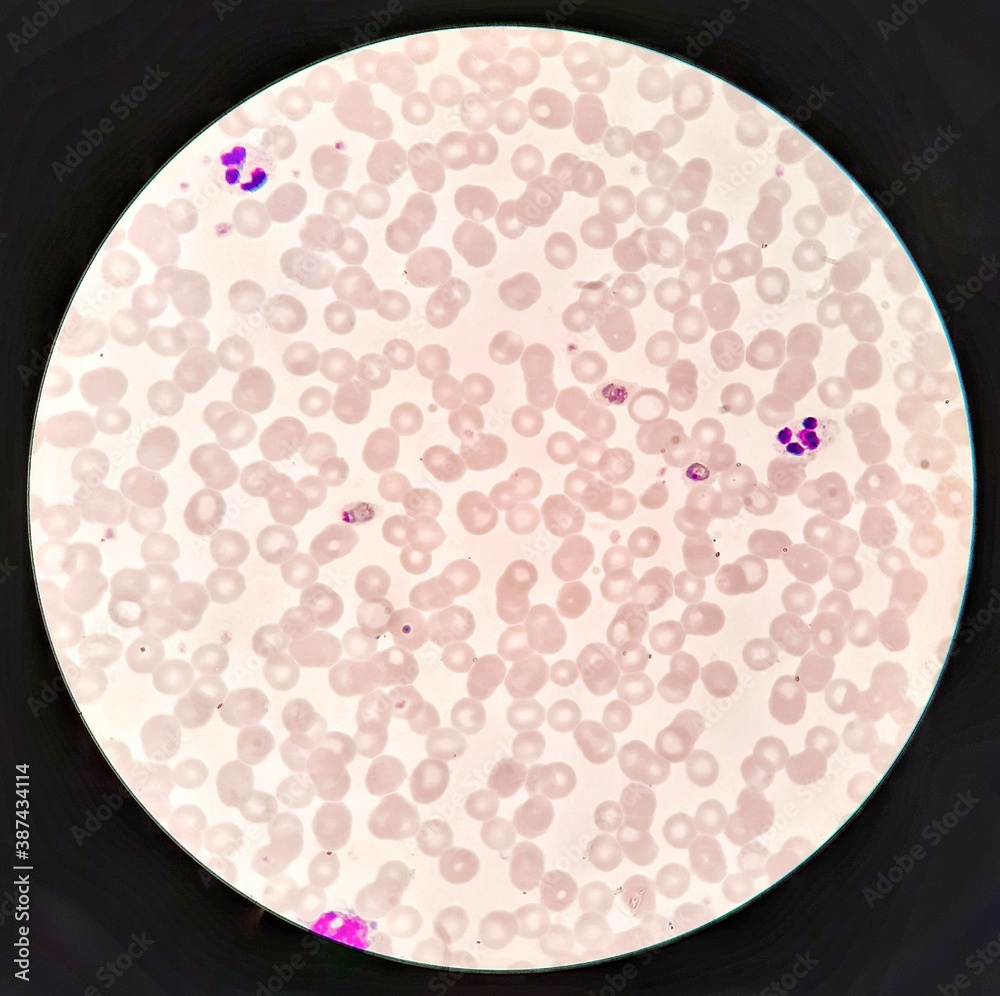 Human parasite form patterns, trophozoite form of Plasmodium ovale ...