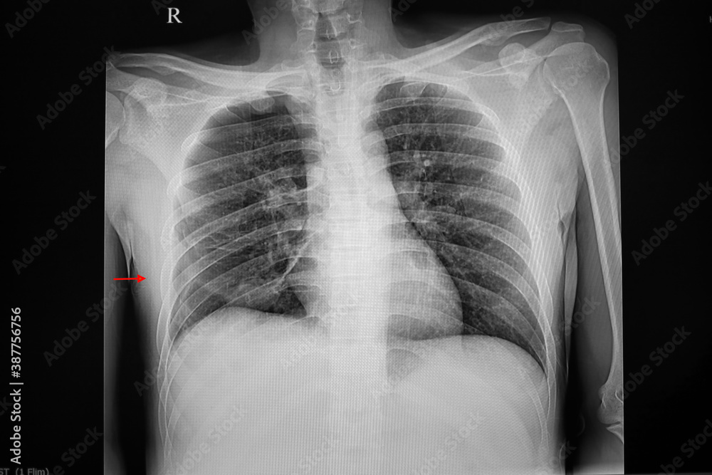 Chest x-ray showing small pneumothorax on the right side of lung Stock ...
