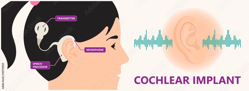 Cochlear implant device electrically stimulates nerve medical aid ear ...