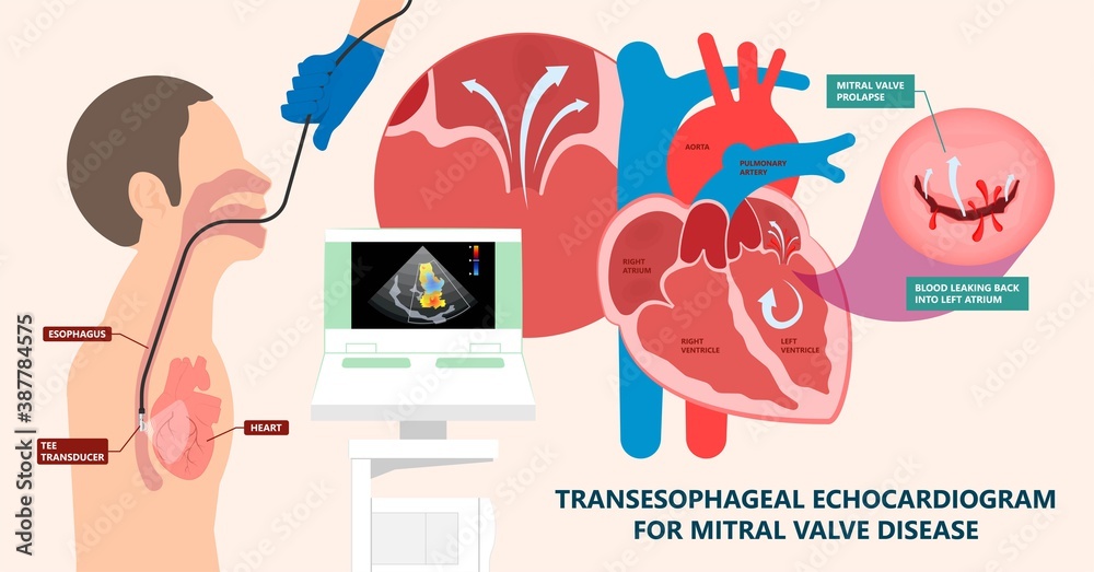 Cath Lab Atrial Septal Defect Tetralogy of Fallot Patent Foramen Ovale ...