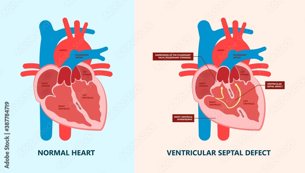 Cath Lab Atrial Septal Defect Tetralogy of Fallot Patent Foramen Ovale ...