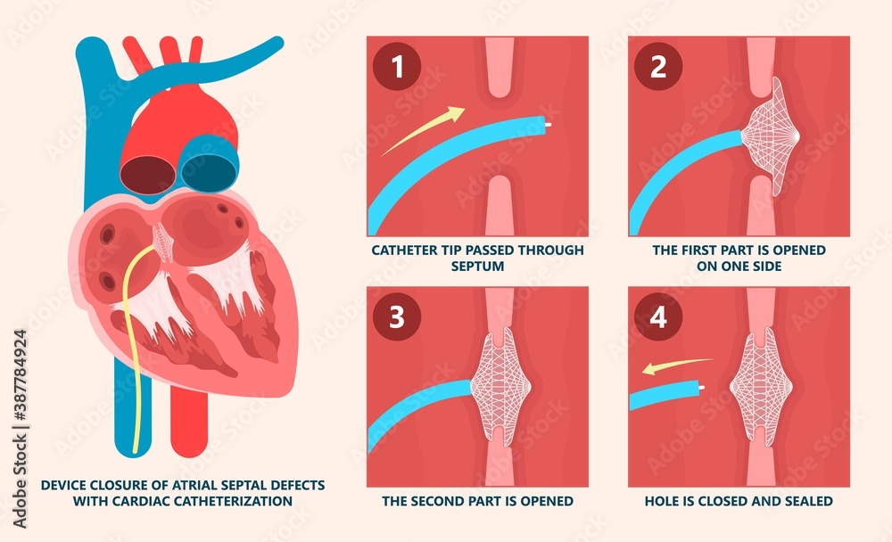 Catheterization For Congenital Heart Defect at Jeremy Burris blog