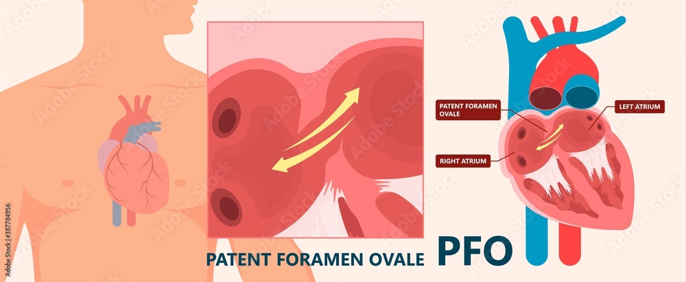 Cath Lab Atrial Septal Defect Tetralogy of Fallot Patent Foramen Ovale ...
