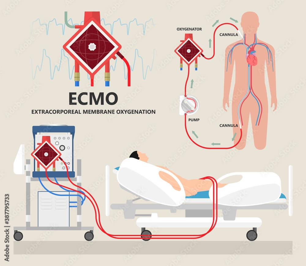 Extracorporeal membrane oxygenation ECMO a life support system for ...