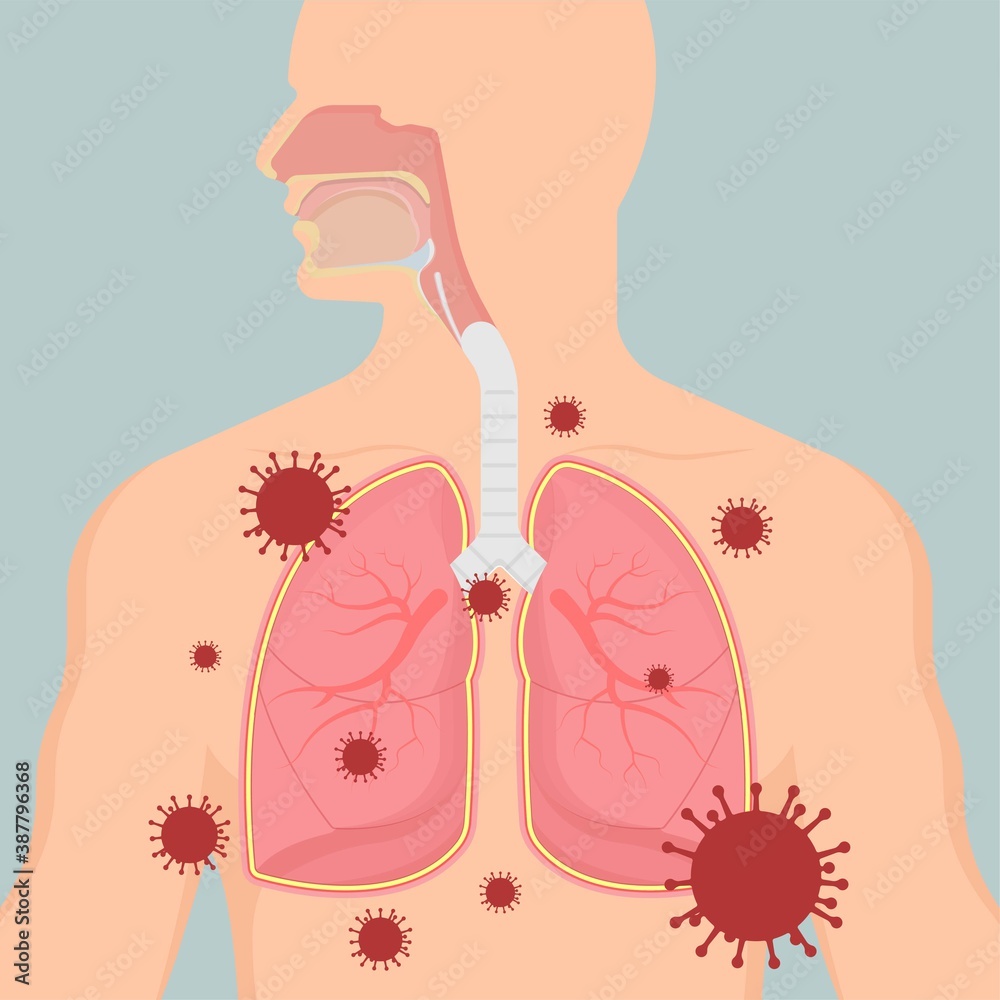 Acute respiratory distress syndrome (ARDS) a respiratory failure and ...