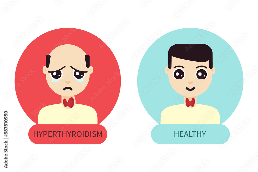 Man with hyperthyroid gland versus healthy man. Hyperthyroism goiter ...