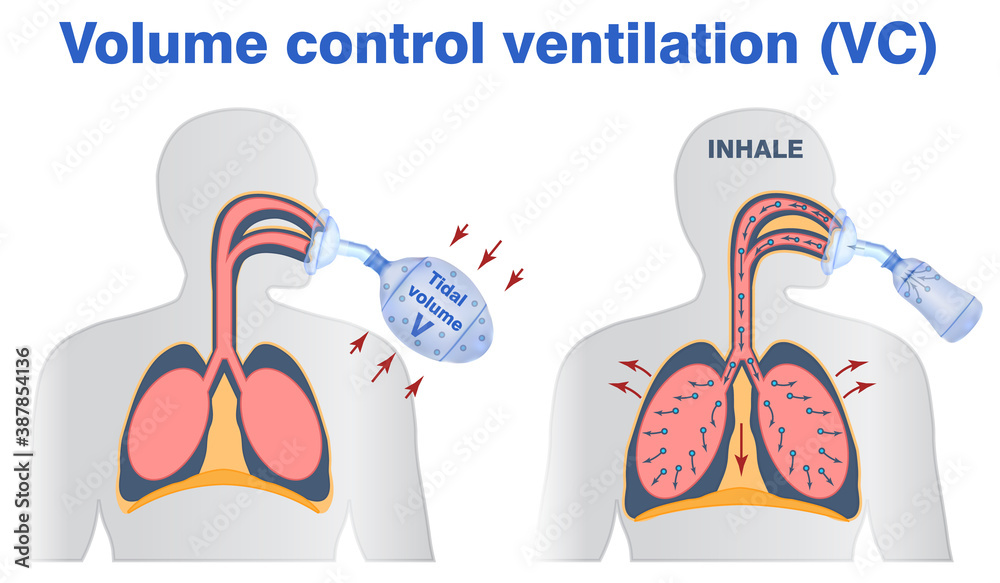 Illustration of vollume control or support artifitial ventilation ...