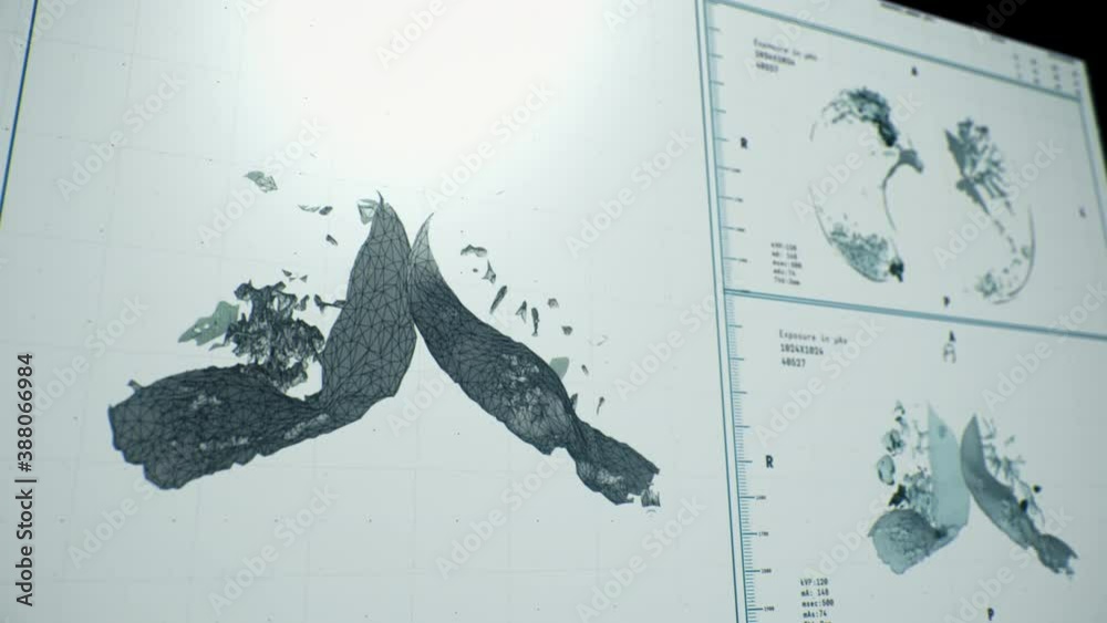 Computer user interface of modern medical scan for covid-19 pneumonia ...