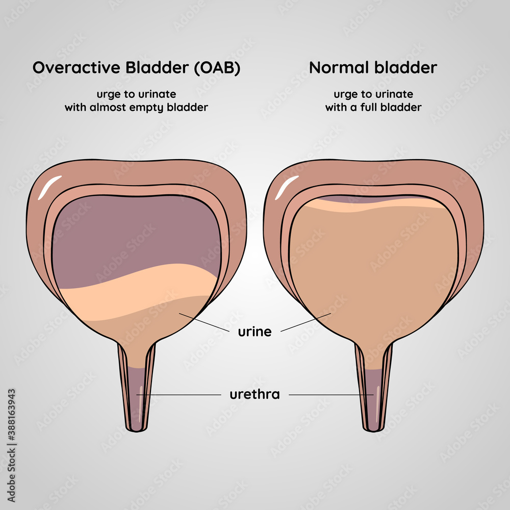 Overactive and normal bladder. Urinary system disease. Urology. Medical flat vector illustration ...