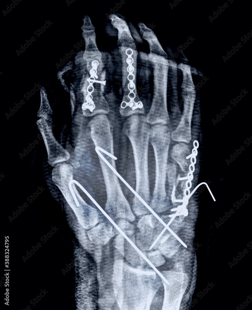 Plakat radiografía corrección fractura dedos de la mano ...