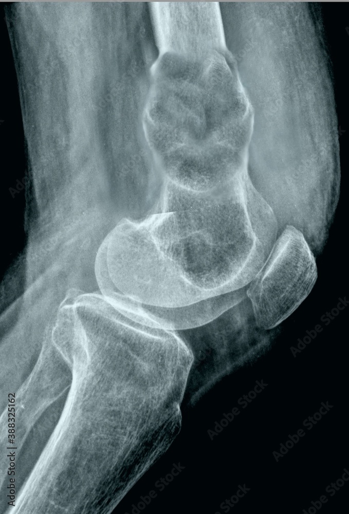 radiografía lateral de fémur con tumor oseo avanzado Stock Photo ...