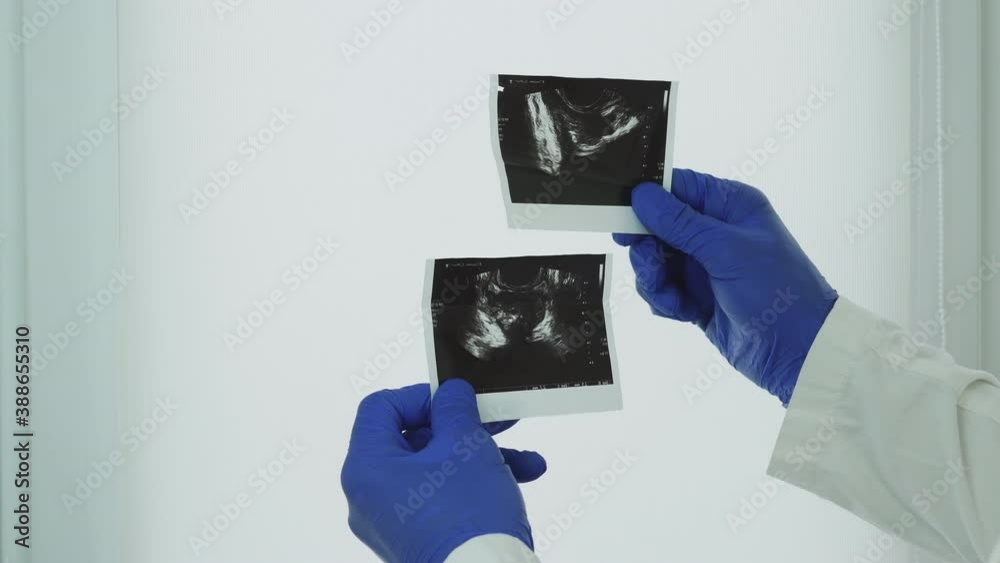 An ultrasound scan of the prostate, in the hands of a doctor, an ...