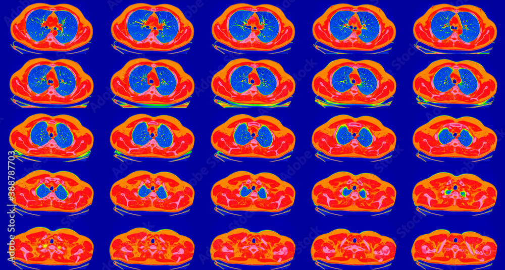 Computed tomography of the lungs in a healthy adult man. Normal lungs ...