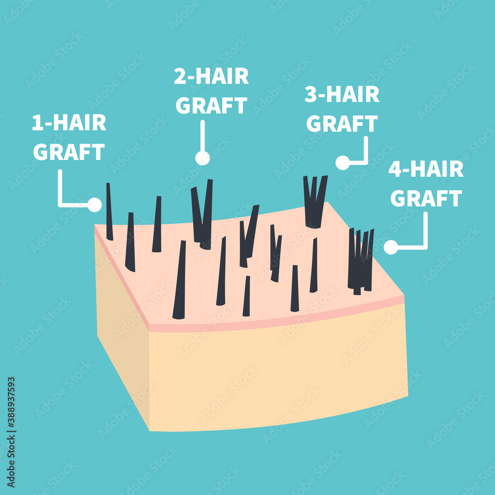 Hair micrograft classification set for hair transplantation surgery ...