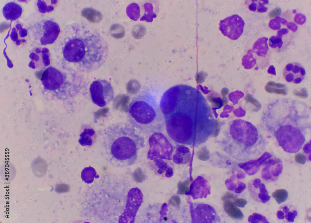 Mesothelial cells in body fluid sample. Stock Photo | Adobe Stock
