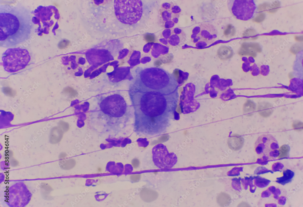 Mesothelial cells in body fluid sample. Stock-Foto | Adobe Stock
