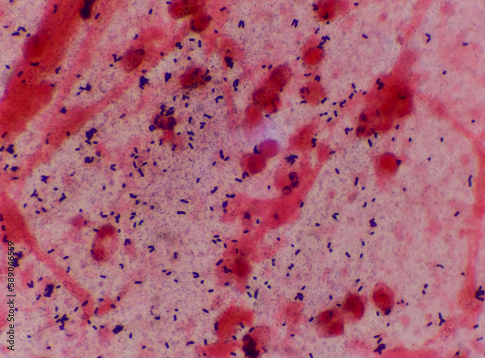 Bacteria Gram positive in sputum gram stain. Stock Photo | Adobe Stock