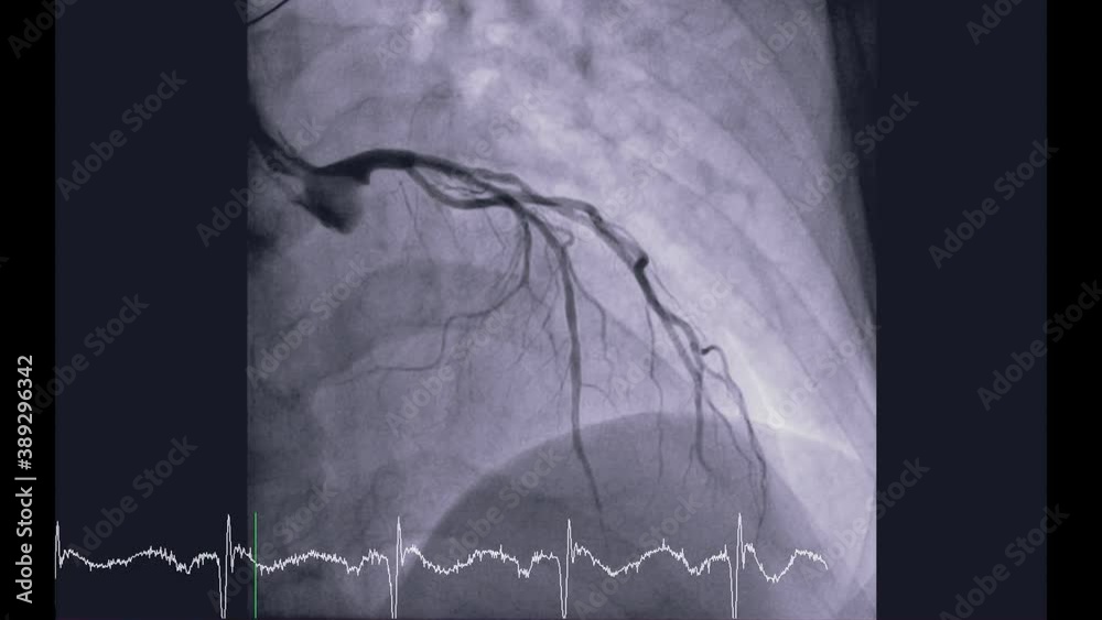Coronary angiography is a test used to find out how much narrowing ...