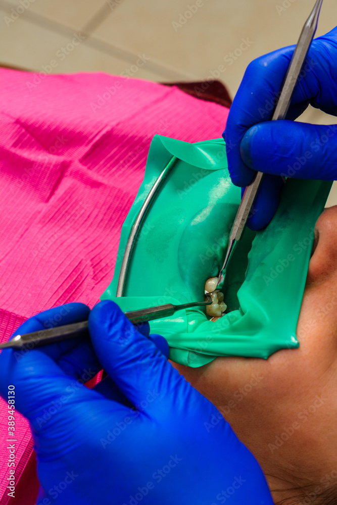 dentist treats the tooth with modern methods, uses a rubber dam ...