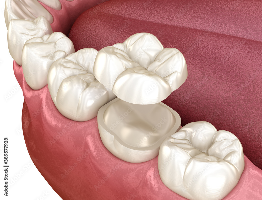 Onlay ceramic crown fixation over molar tooth. Medically accurate 3D ...