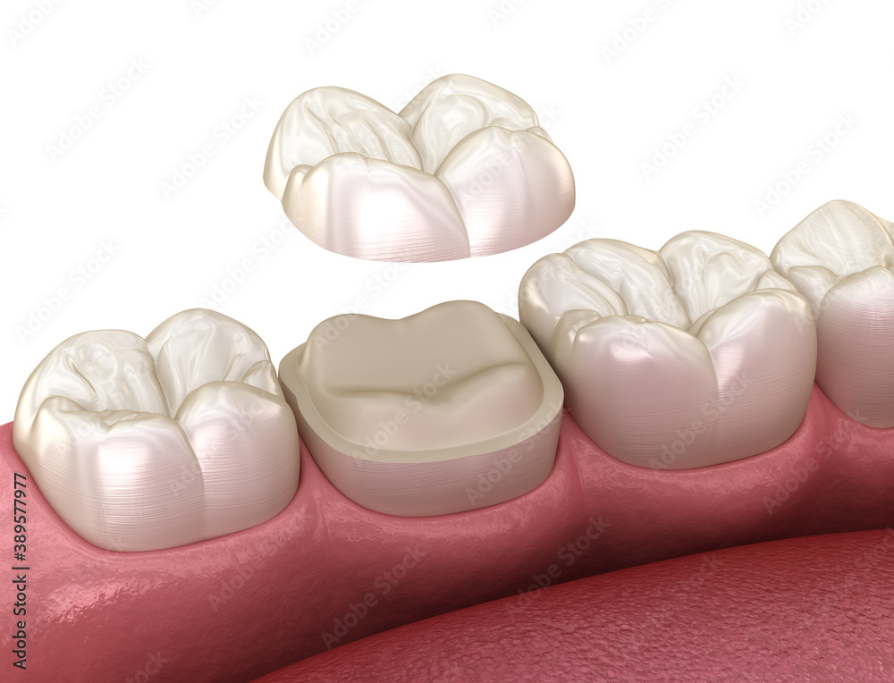 Onlay ceramic crown fixation over molar tooth. Medically accurate 3D ...