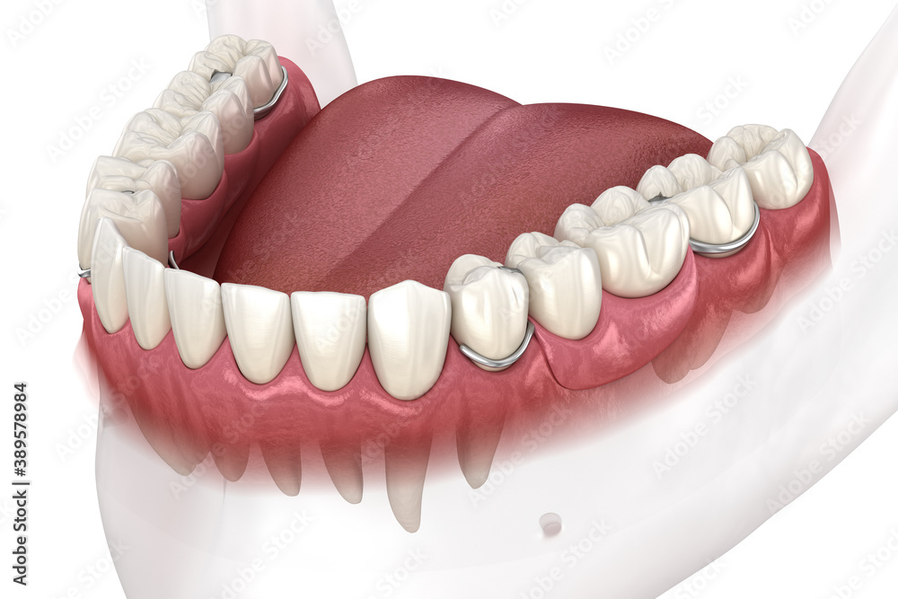 Removable partial denture, mandibular prosthesis. Medically accurate 3D ...