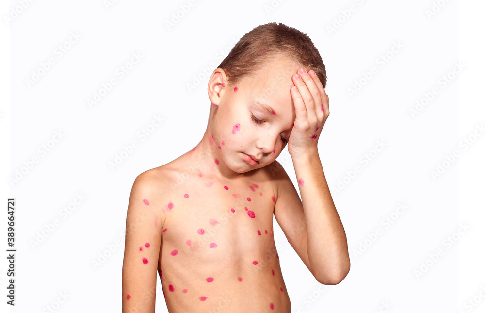 A little boy with chickenpox on a white background puts his hand to his ...