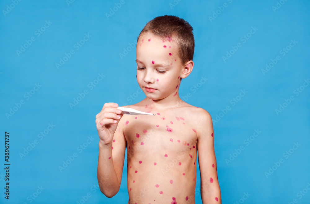A little cute boy with a red rash on his body stands on a blue ...