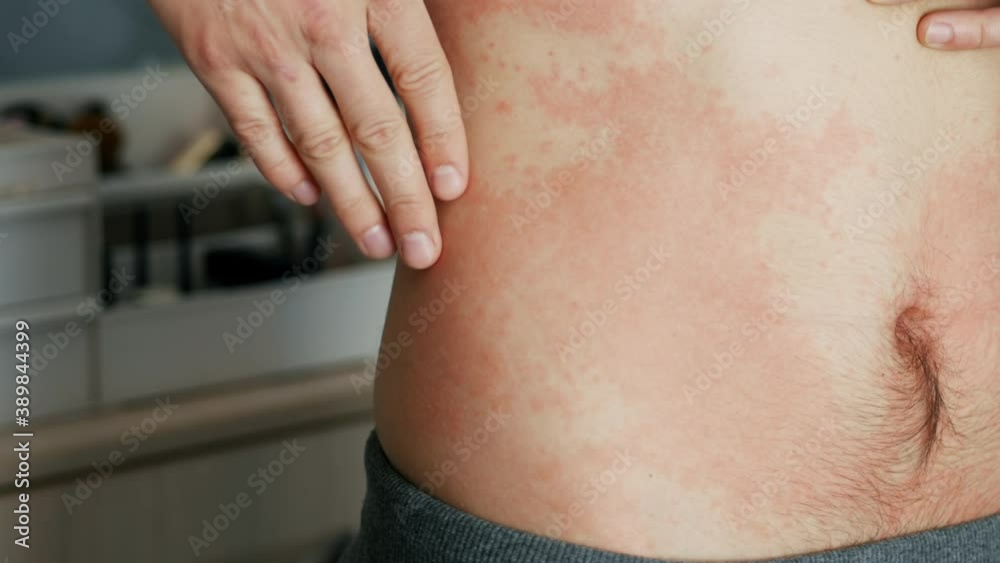 Close-up man scratches a red rash on his stomach in close-up. Allergies ...