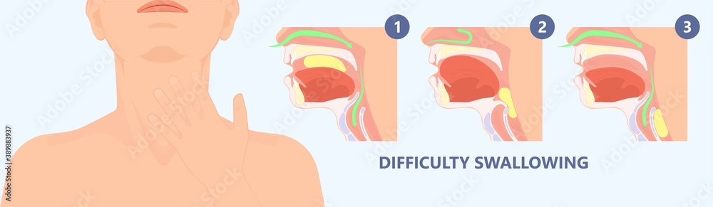 Vecteur Stock Dysphagia infection trachea examine Surgery choking ...
