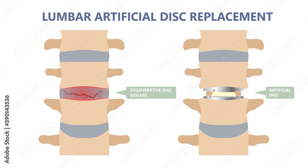 Artificial Disc for Treatment the Degenerative Disc Disease arthritis ...