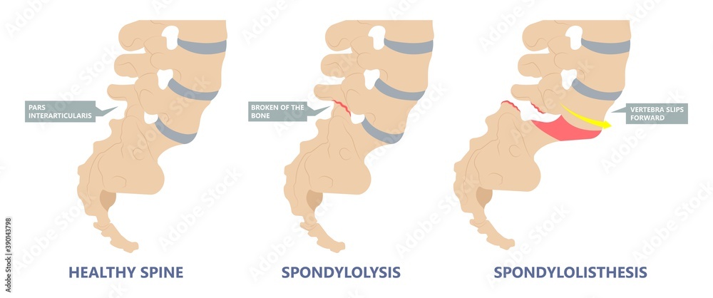 Spondylolisthesis a spinal disease that causes one of the lower ...
