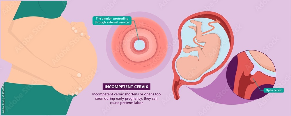 Incompetent cervix cervical insufficiency weak tissue premature stitch ...