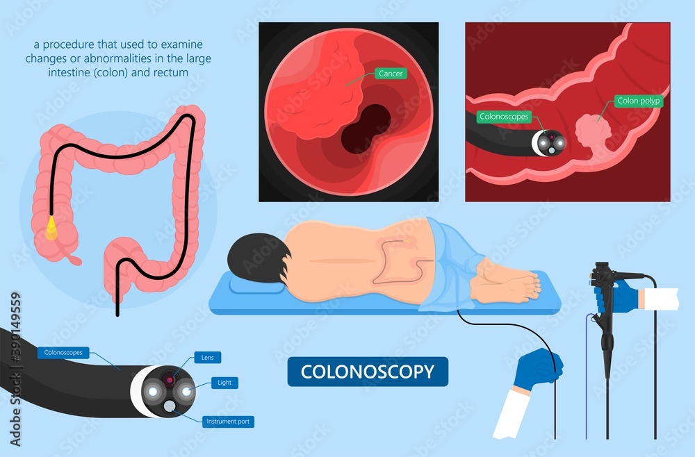 Polypectomy procedure to remove polyps from the colon medical Stock ...