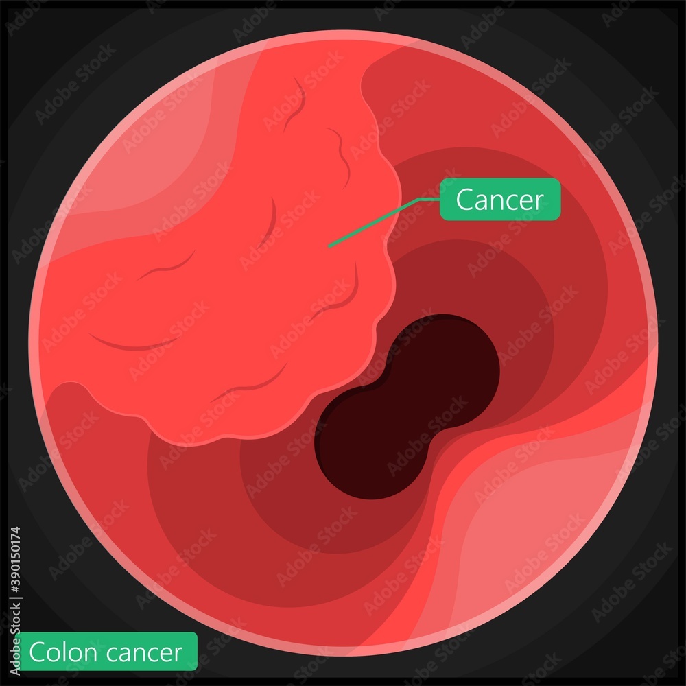 Polypectomy procedure to remove polyps from the colon medical Stock ...