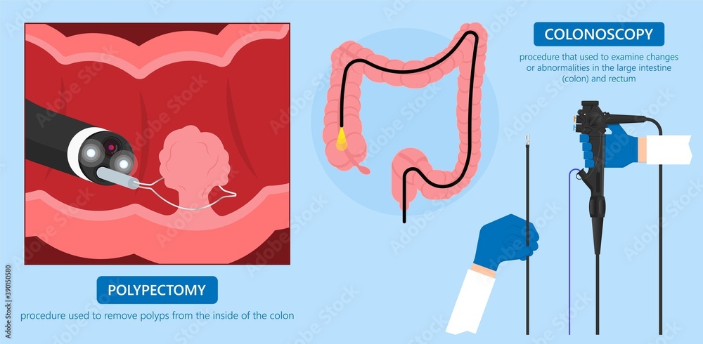Polypectomy procedure to remove polyps from the colon medical Stock ...
