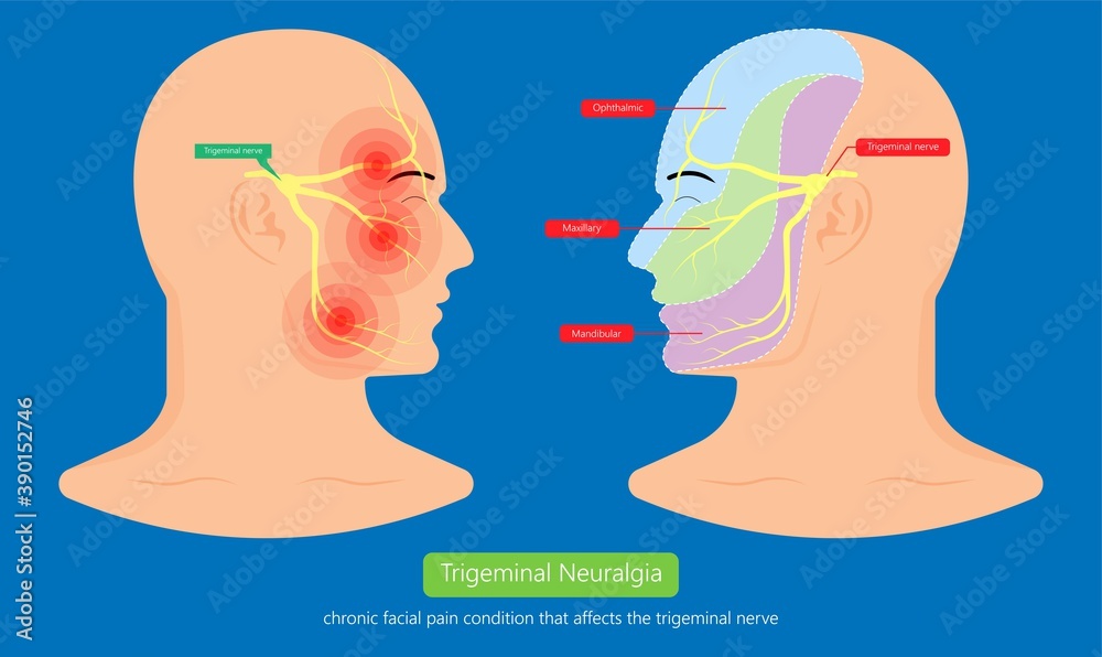 Trigeminal neuralgia chronic pain of facial TMD injury ophthalmic ...
