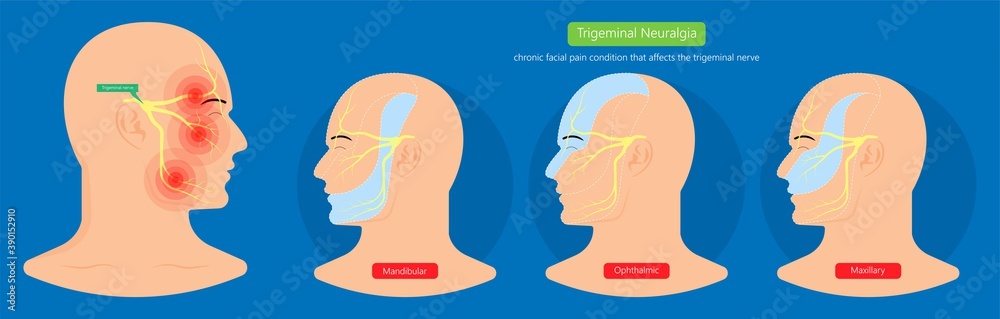 Trigeminal neuralgia chronic pain of facial TMD injury ophthalmic ...