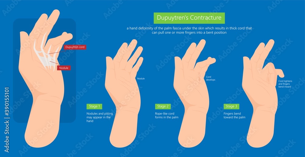 Dupuytren's contracture palm tissue disease Stock Vector | Adobe Stock