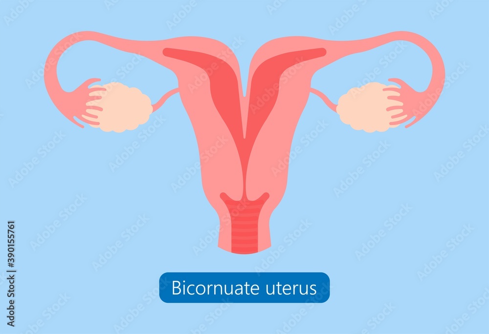 Abnormal uterus Tipped septum missed mature cervix double absent defect ...