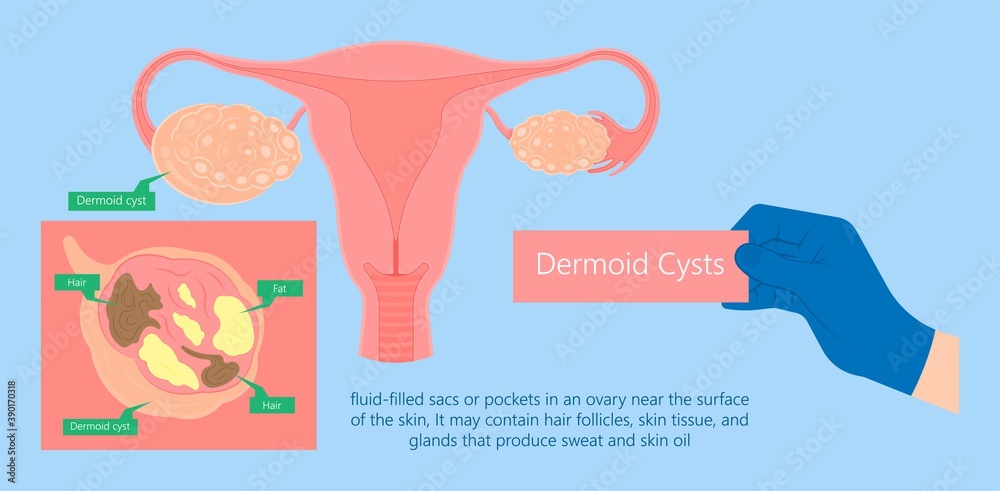 Vetor de Ovarian Dermoid cysts symptoms of uterus cancer do Stock ...