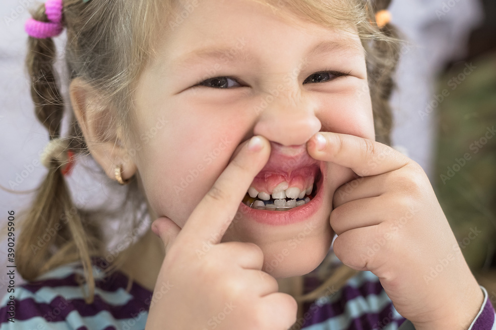 Adult permanent teeth coming in front of the child's baby teeth: shark ...