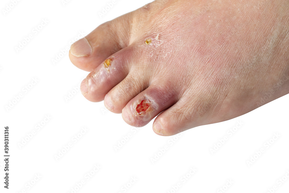 wound scab injury on leg skin, Disabled handicapped Stock Photo | Adobe ...