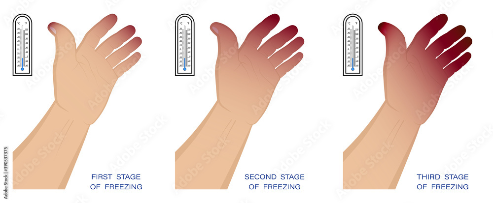 hand of man with different stages of frostbite. Freezing and skin ...