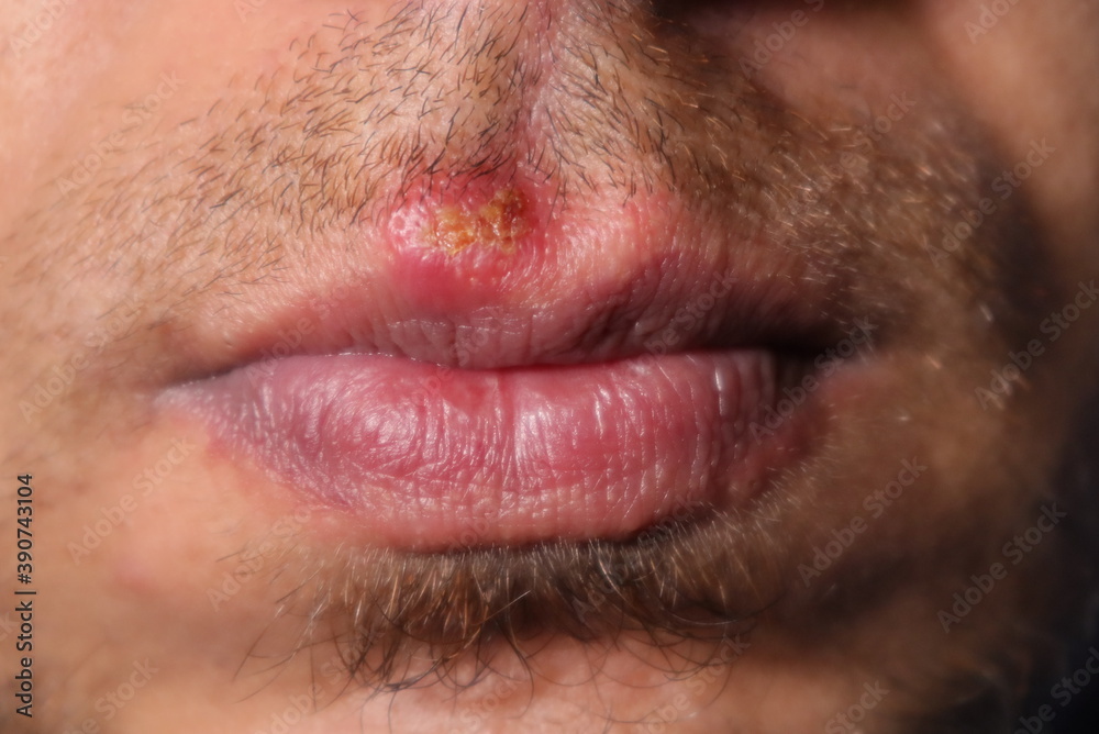 Herpes Simplex Virus (HSV) Mouth Infection. herpes simplex virus type 1. herpes simplex labialis ...